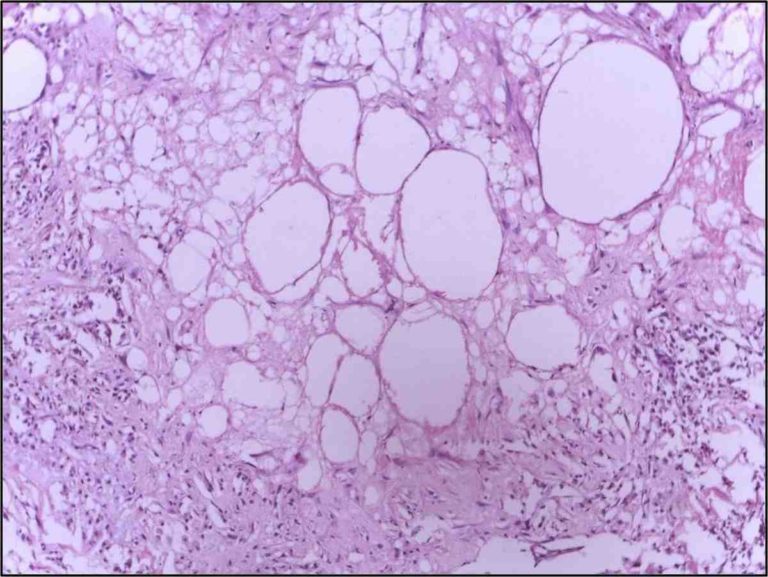 Apoptose cellulaire et nécrose cellulaire - Mort cellulaire programmée ...